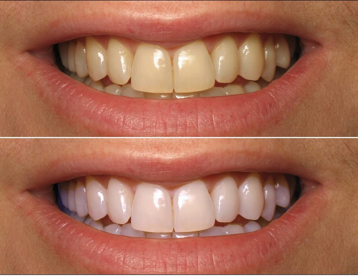 1 Hour Bleaching – Dr. Mansuri's Cosmetic Dental Clinic